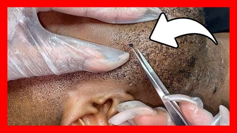 Cómo Prevenir y Tratar los Pelos Enquistados en la Vulva: Guía Completa ...