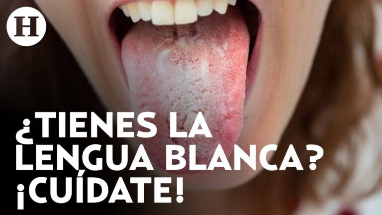 Manchas Blancas Debajo de la Lengua: Causas, Síntomas y Tratamientos ...